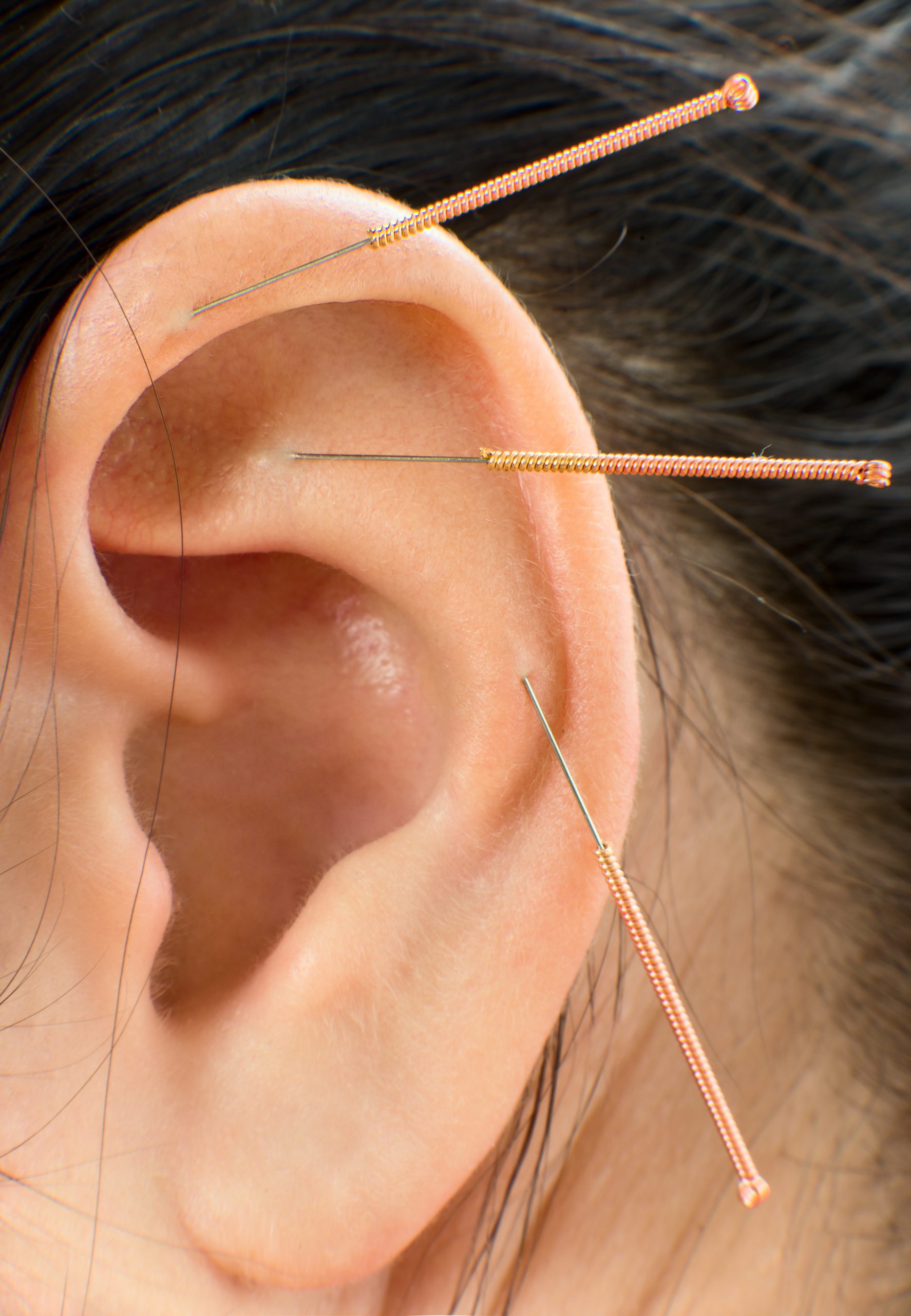 Vicky Appleton Acupuncture - North Leeds